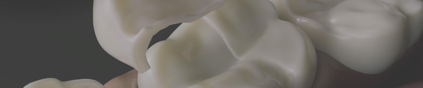 Dental Inlays and Onlays in Chattanooga, TN | Frank Trundle DDS